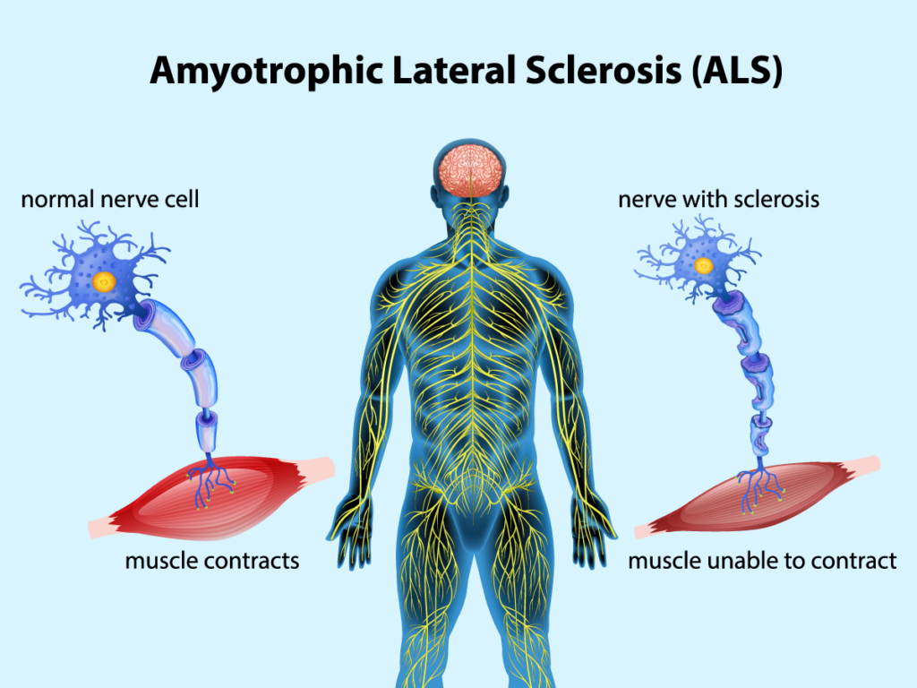 Amyotrophic Lateral Sclerosis (ALS) :- Symptoms, Causes,risk Factors ...